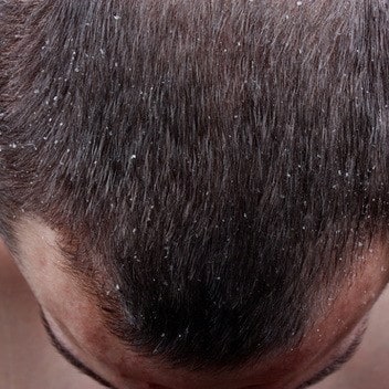 ¿Cómo deshacerse de la caspa? diciembre 2025